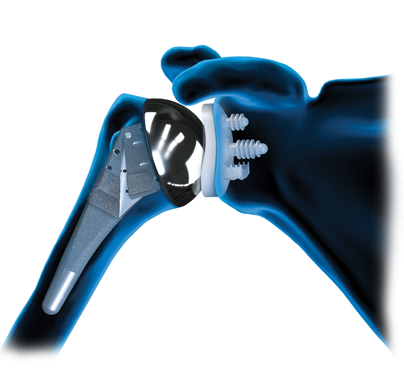 Arthrex - Univers Apex OptiFit™ Total Shoulder System Arthrex - Univers Apex OptiFit™ Total Shoulder System